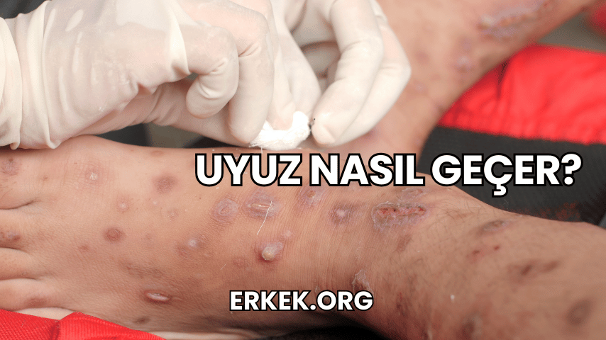 Uyuz Nasıl Geçer? - Erkek